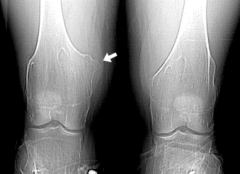 Osteochondroma & Multiple Hereditary Exostosis - Pathology - Orthobullets